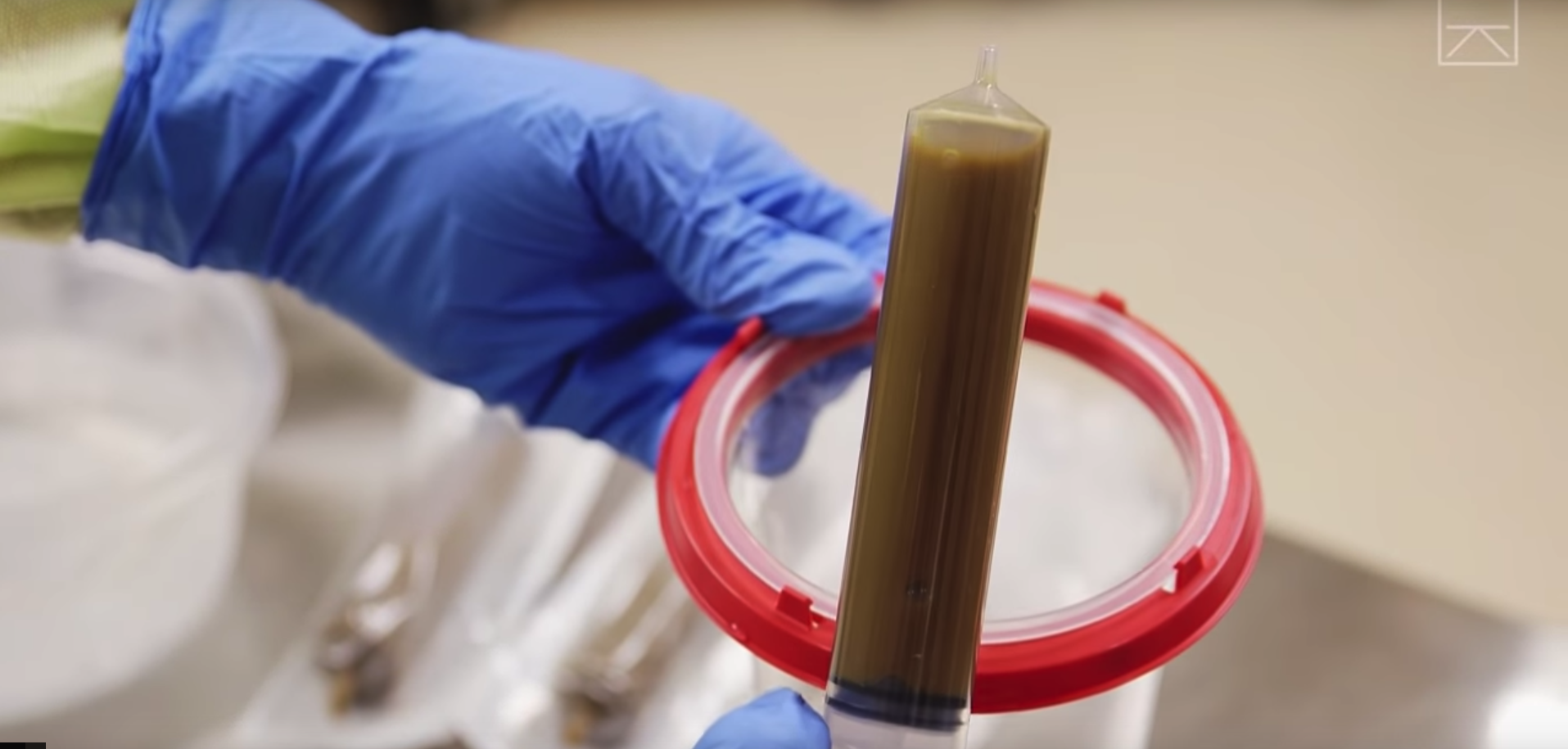 Anaerobic stool processing boosts FMT efficacy in ulcerative colitis