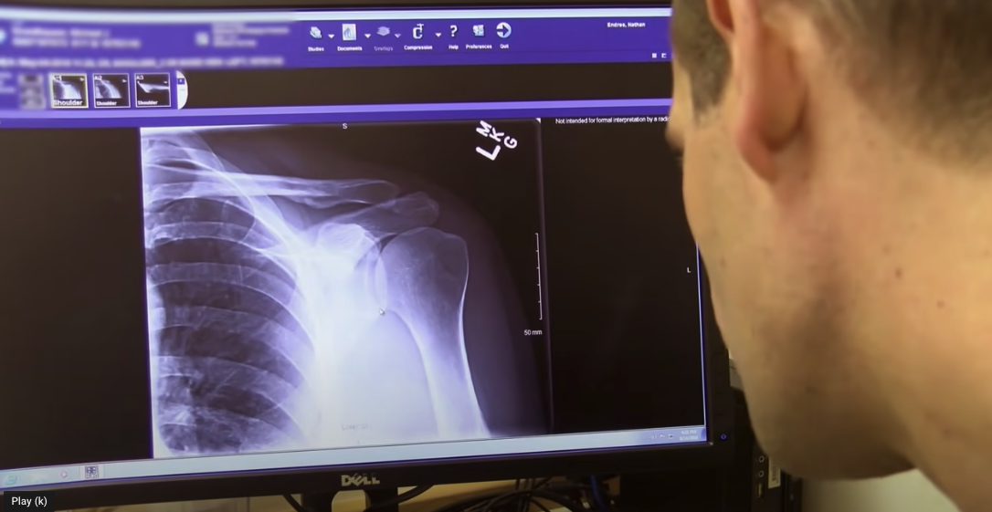 Time to strengthen evidence for and management of shoulder OA