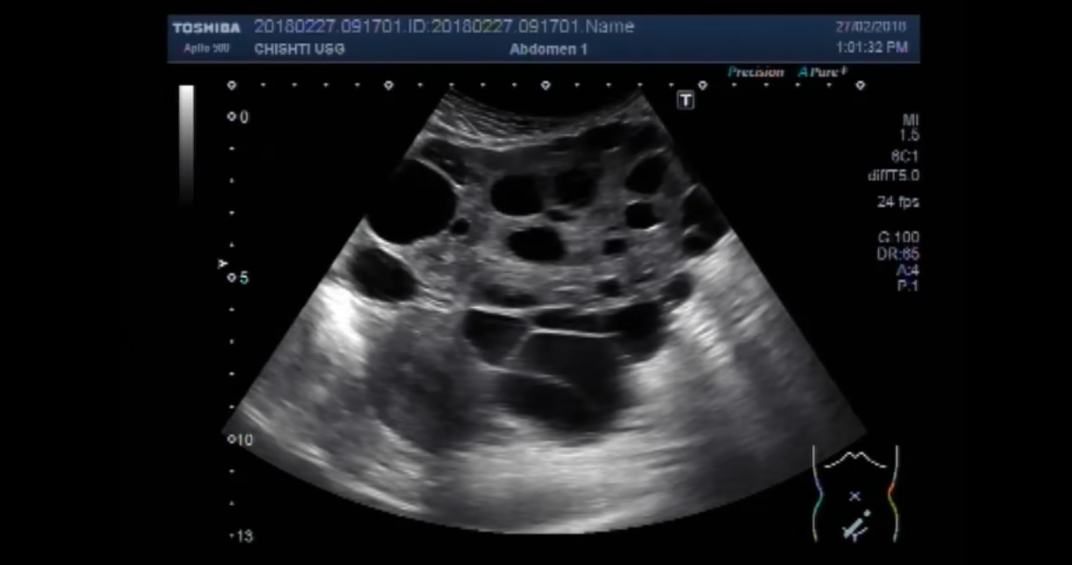 Adolescent PCOS guidelines tighten diagnostic criteria