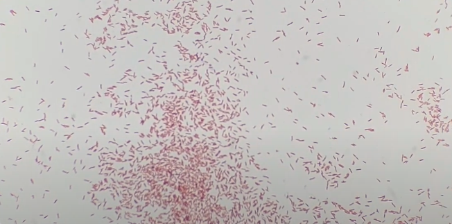 Bronchiectasis is ‘no longer rare nor orphan’ disease: study