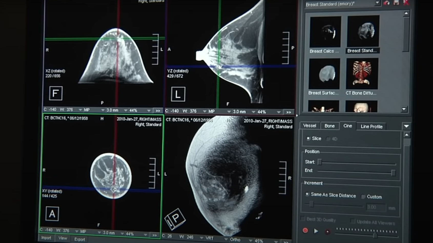 Ribociclib offers advantage in adjuvant therapy in early breast cancer