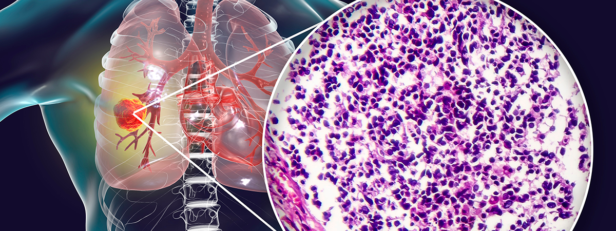 ‘Highly meaningful’ benefit with adjuvant alectinib in NSCLC