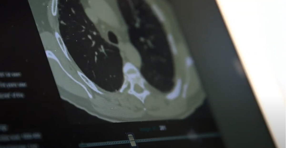Respiratory specialists the focus of lung screening protocols