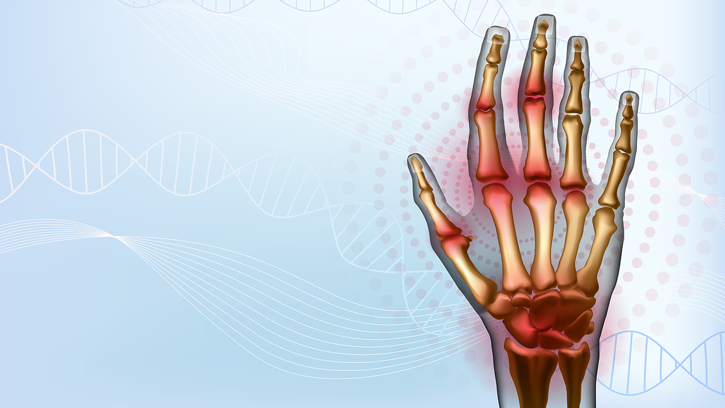 Most difficult-to-treat RA non-inflammatory, study reveals